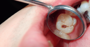How Can I Make My Tooth Extraction Heal Faster Naturally | Dental Faith